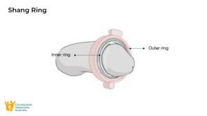 Adult Circumcision: What Happens During the Procedure - Circumcision Vasectomy Australia