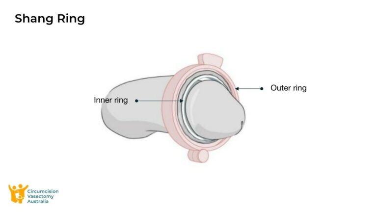 Adult Circumcision: What Happens During the Procedure - Circumcision ...